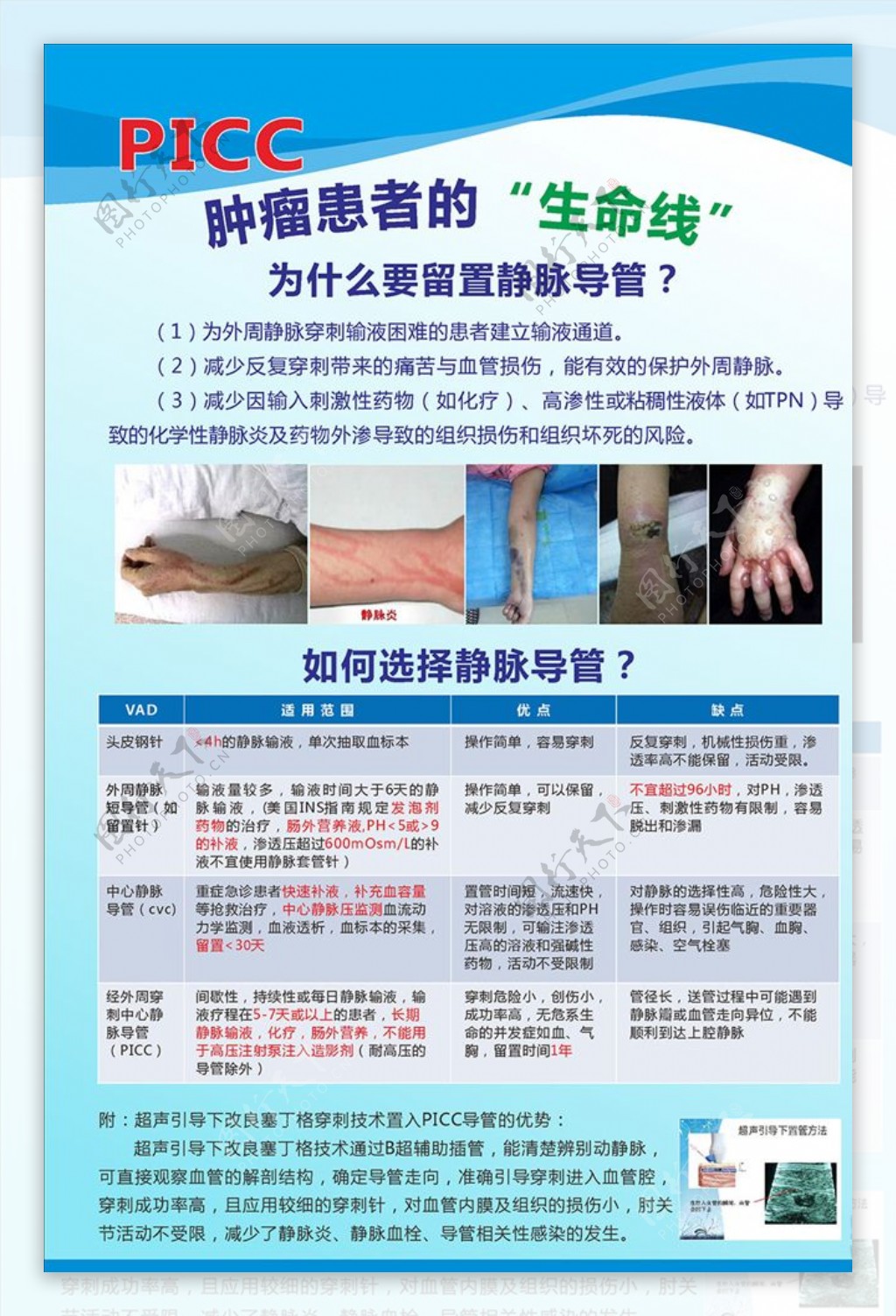 PICC肿瘤患者的生命线图片素材-编号36405048-图行天下